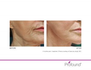 Profound-before and After 1 - SKIN MediSpa