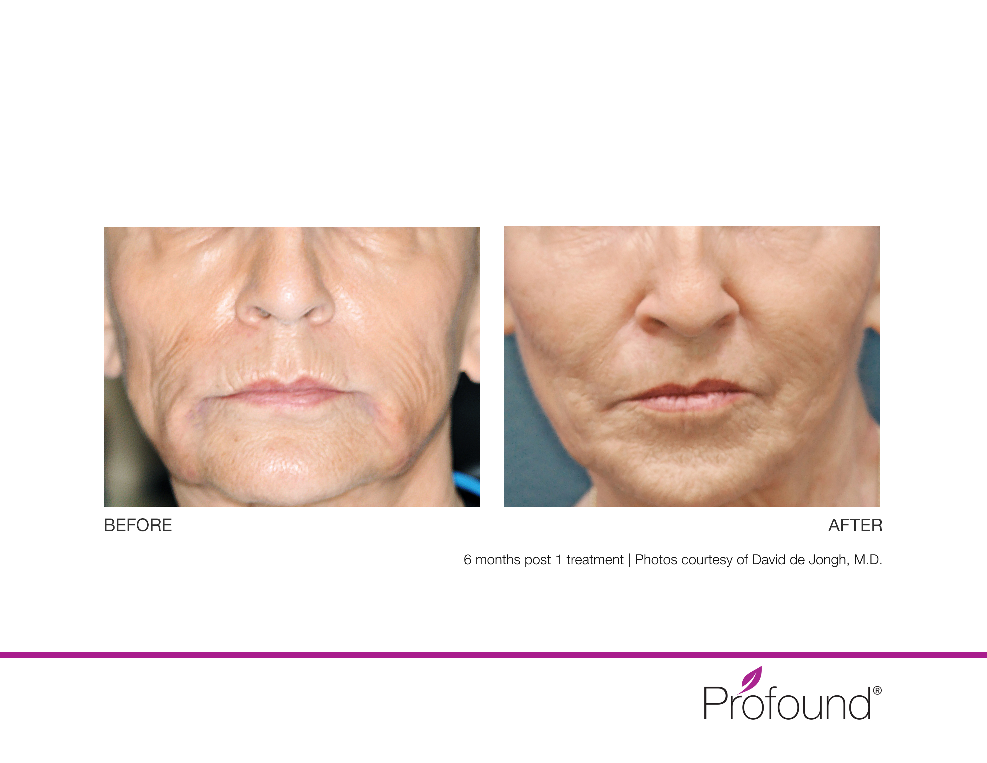 Profound-before and after 3 - SKIN MediSpa